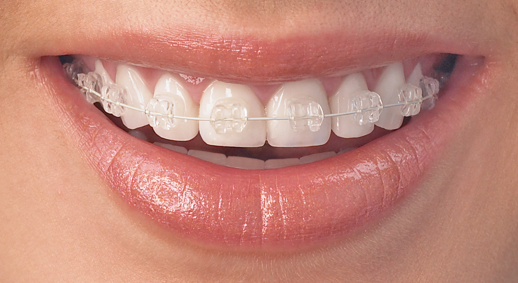 Ceramic Braces With White Wire Types Of Braces | Braces & Invisalign