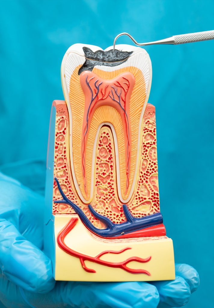 [NEW] Root Canal Therapy - Malmin Dental