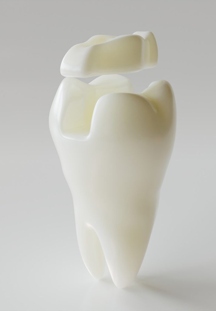 [NEW] Inlays, Onlays & Restorative Fillings - Malmin Dental