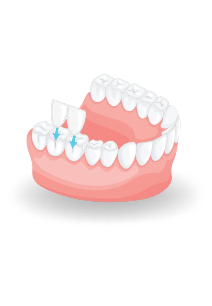 [NEW] Veneers, Crowns & Smile Makeovers - Malmin Dental